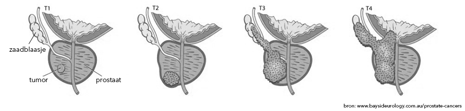 Prostaatkanker in Nederland